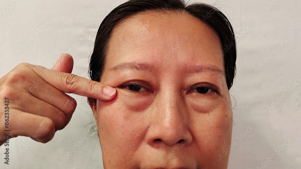 Portrait the fingers holding the flabbiness adipose sagging skin, swelling and ptosis beside the ...