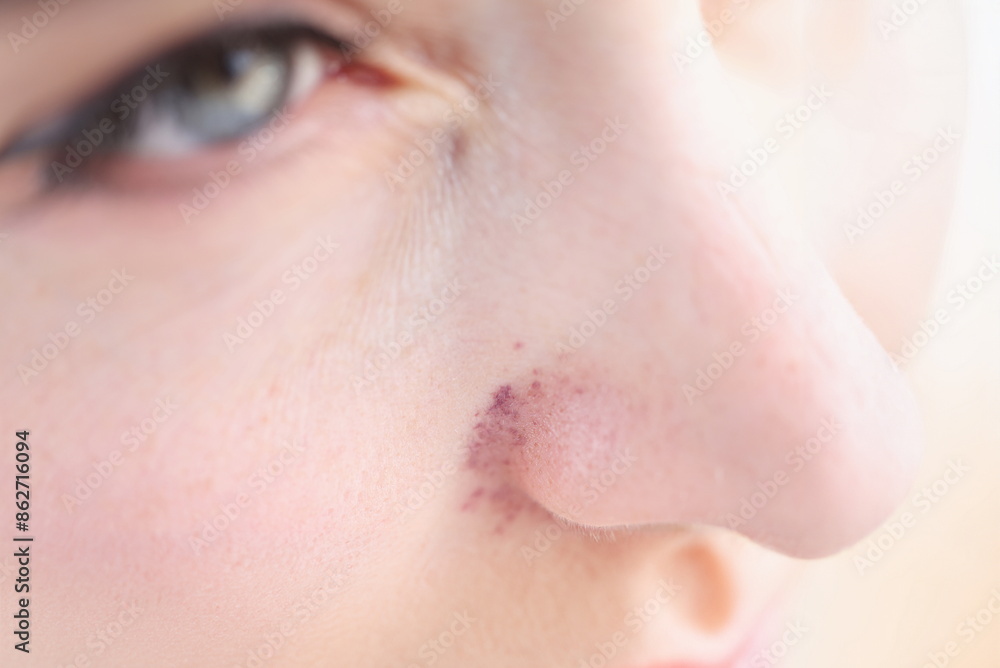 Red cyanotic rash on woman nose closeup. Symptoms of hemorrhagic ...