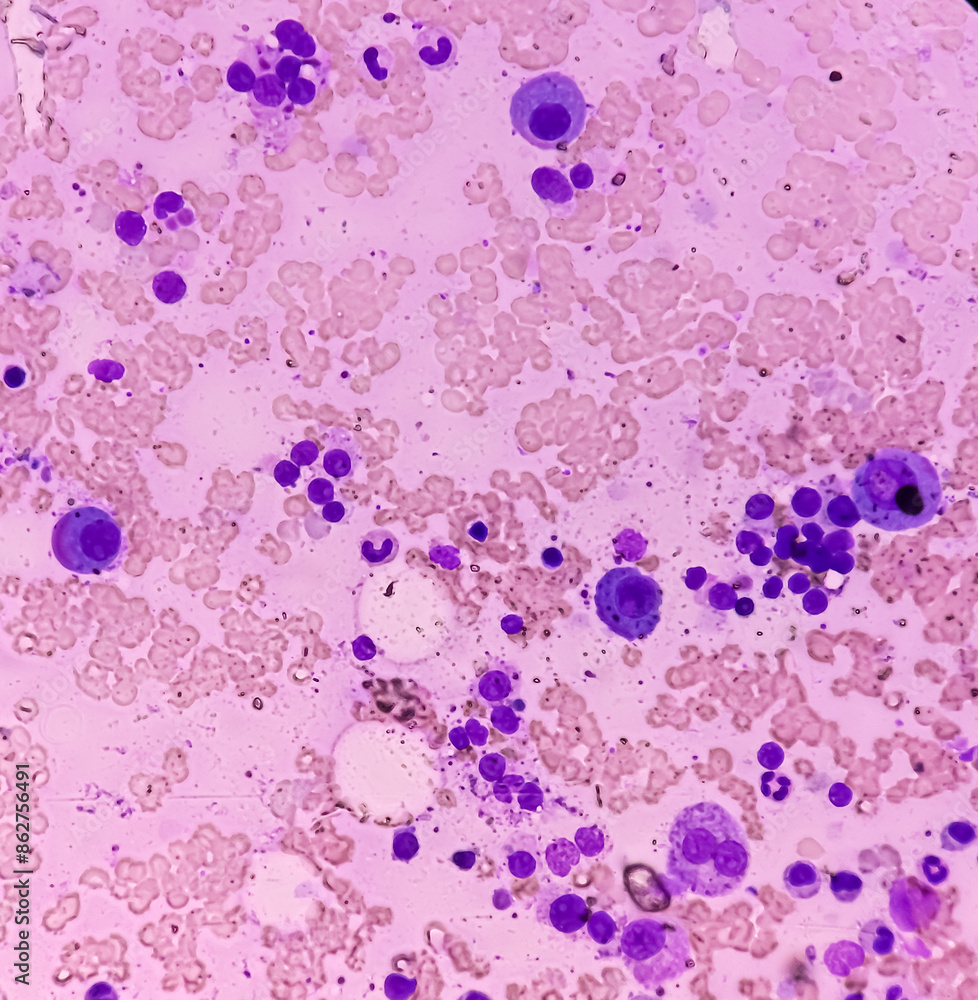 Acute leukemia, ALL(Acute lymphoblastic leukemia), peripheral blood ...
