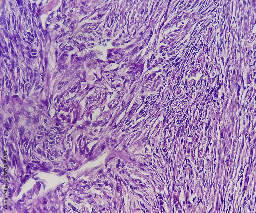 Microscopic image of Papillary borderline serous tumor of the ovary ...