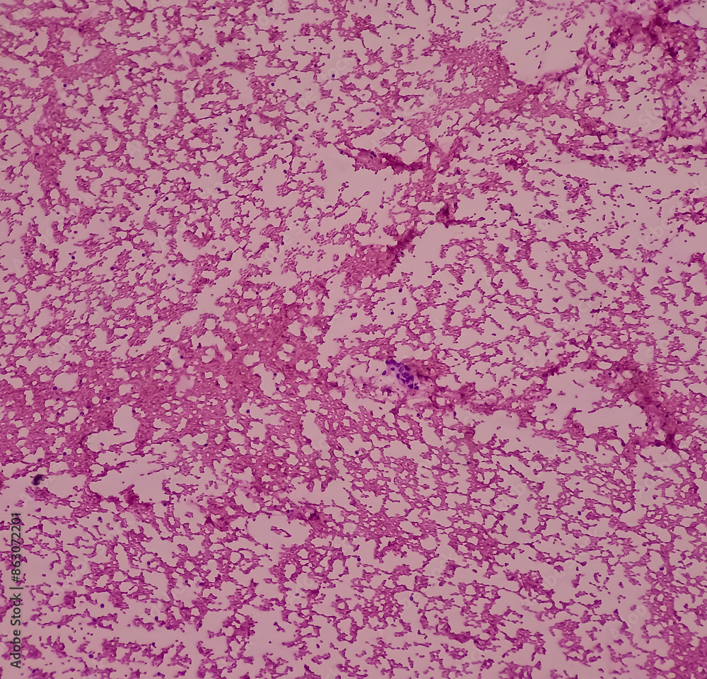 Gluteal region Tumor Cytology. Organizing abscess. Smear show plenty of ...