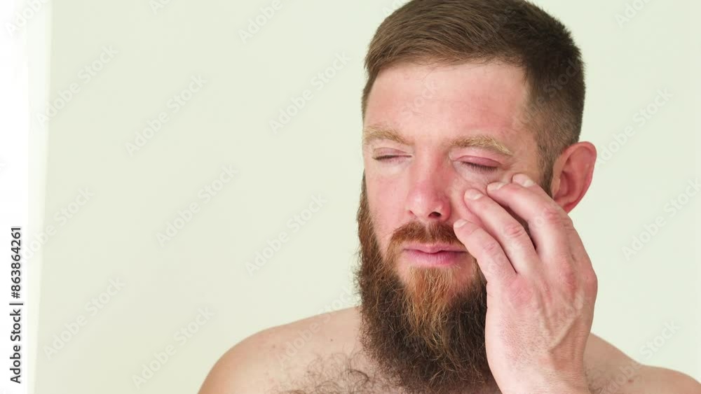 Male patient's infected eye. The blue-eyed bearded man staring at the ...