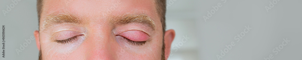 Foto de Male patient's infected eye. The blue-eyed bearded man staring ...