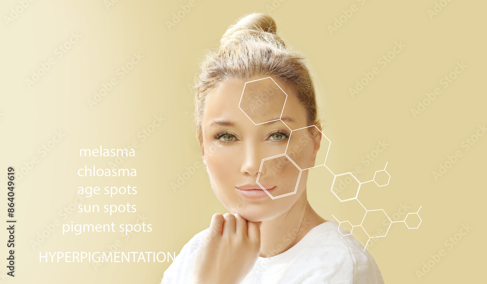 Dark spots, freckles,hyperpigmentation(melasma or chloasma),concept ...