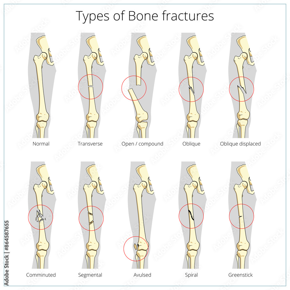 Types of bone fractures medical skeleton anatomy educational PNG ...