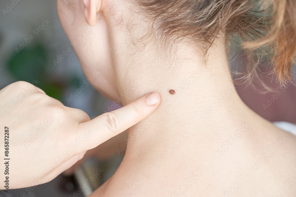 Woman examing her abnormal mole. Dermatology procedure. Doctor checking ...