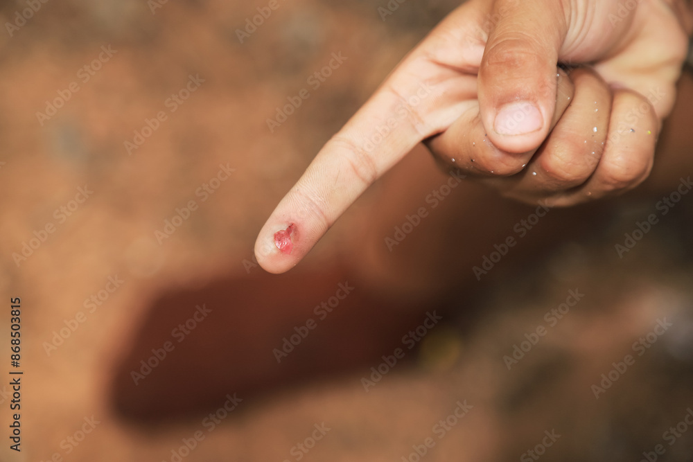 kid showing wound on finger from playing in playground Stock Photo ...