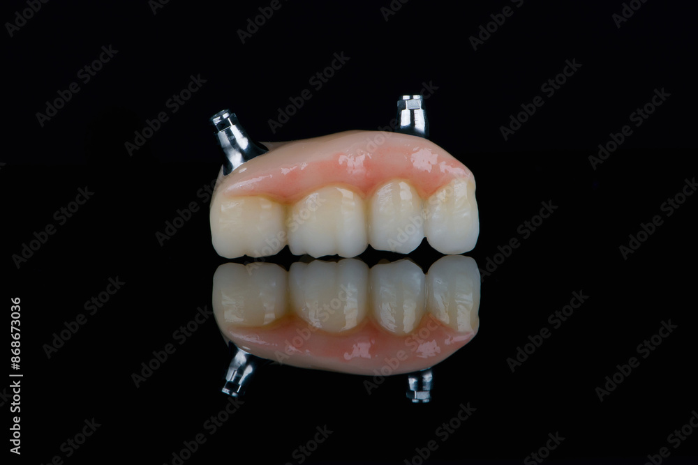 Dental bridge four teeth and artificial gum made of monolithic ...