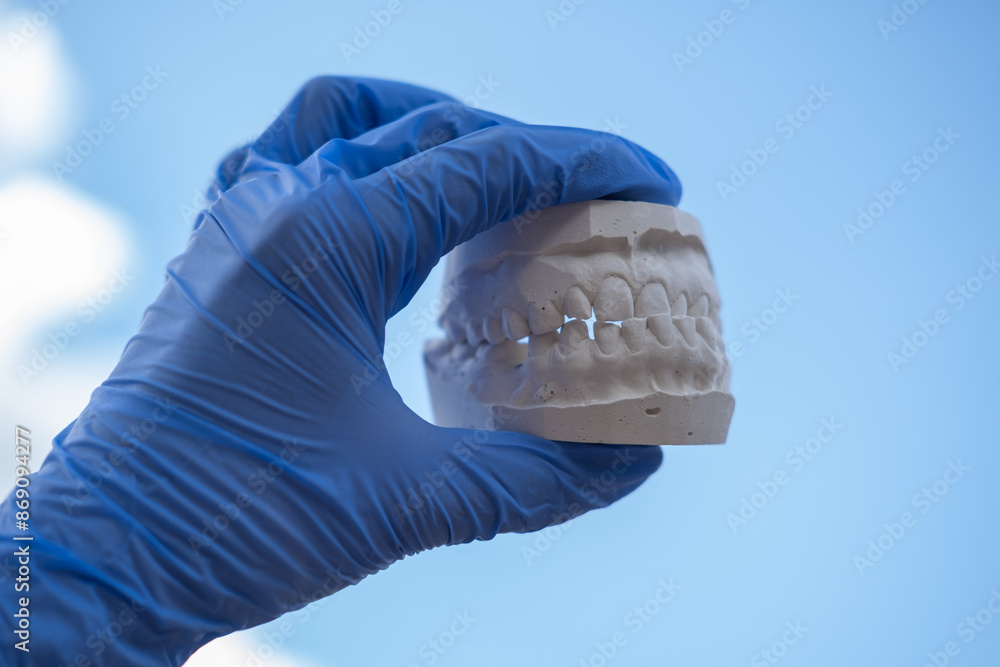 White plaster impression of the dental jaw of a patient with crooked ...