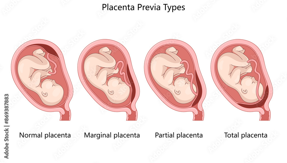 different types of placenta previa, showing normal, marginal, partial ...