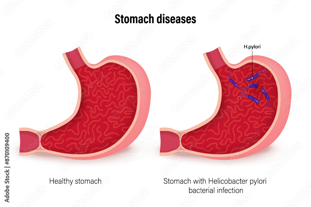 Stomach diseases. Comparison of healthy stomach and Stomach with ...