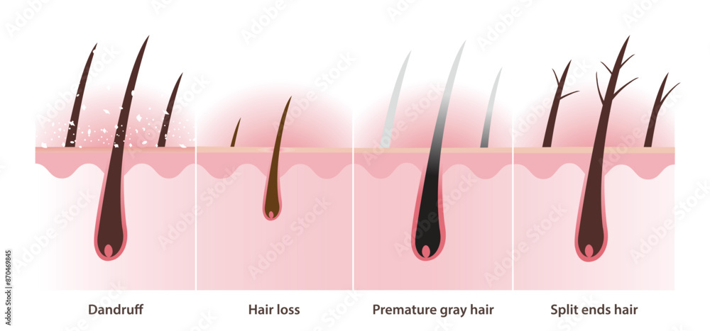 The cross section of hair problems with scalp layer vector illustration ...
