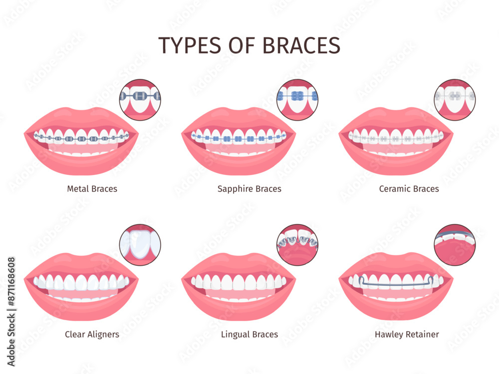Vetor de Braces types. Dental bracket teeth retainer type, metalic ...