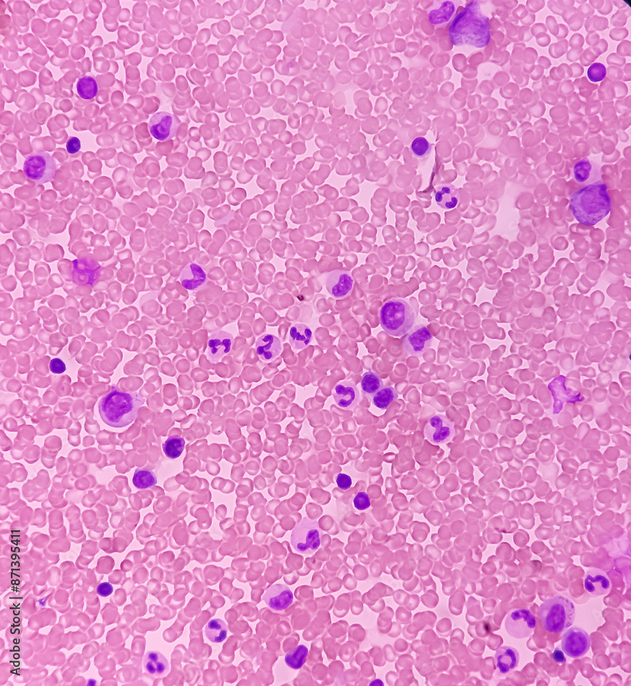 Bone marrow study, microscopically show megakaryocytic pleomorphism ...