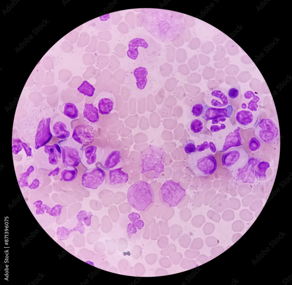 Bone marrow study, microscopically show megakaryocytic pleomorphism ...