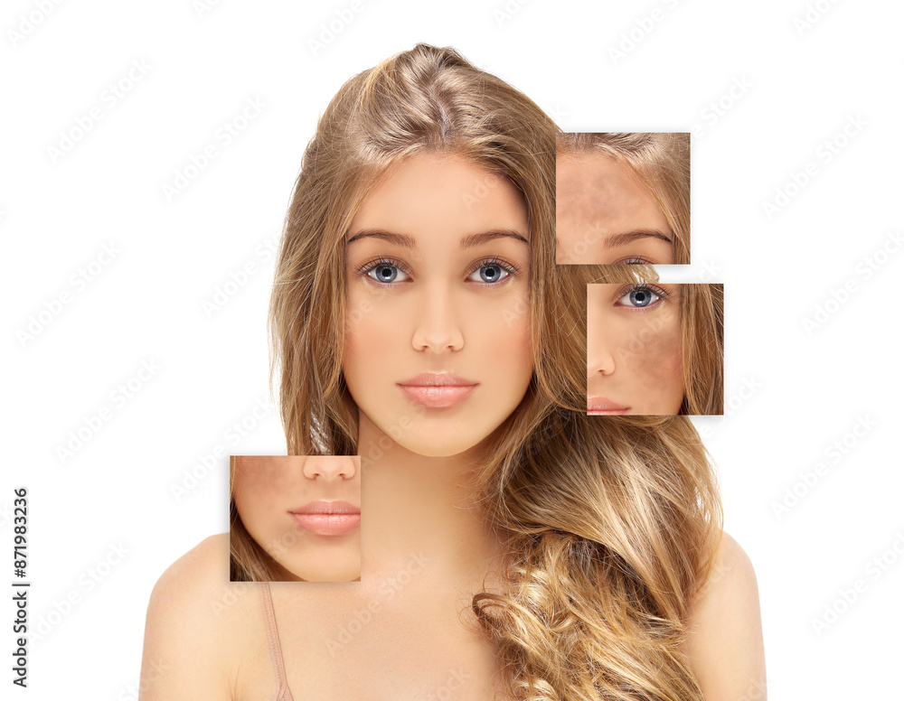 Dark spots, freckles,hyperpigmentation(melasma or chloasma),concept ...