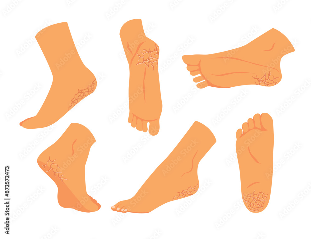 Set of callus cracked heels or feet, labelled plantar hyperkeratosis ...