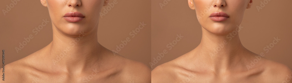 Double chin lift. Female before and after plastic surgery, mentoplasty ...