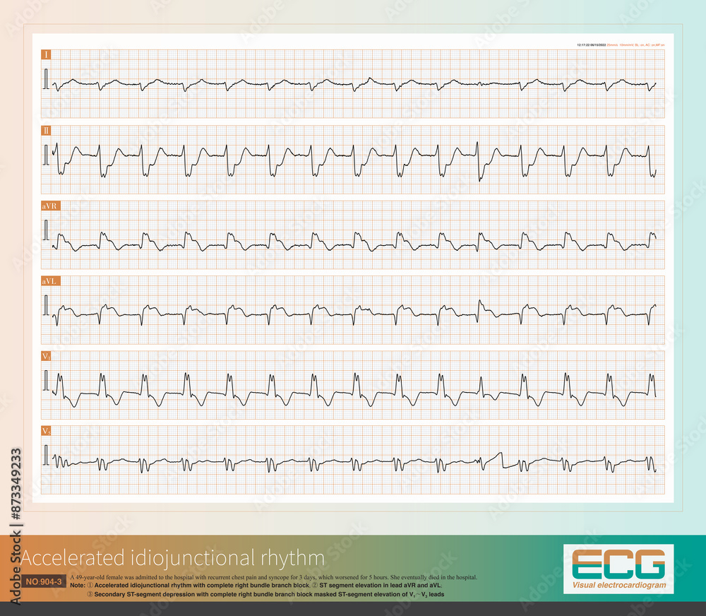 Accelerated idiojunctional rhythm is commonly seen in digitalis ...