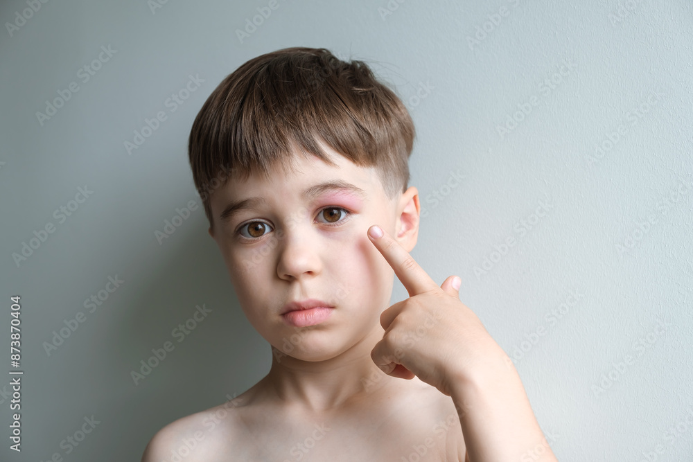 The boy points at his swollen eye from an insect bite. Close-up ...