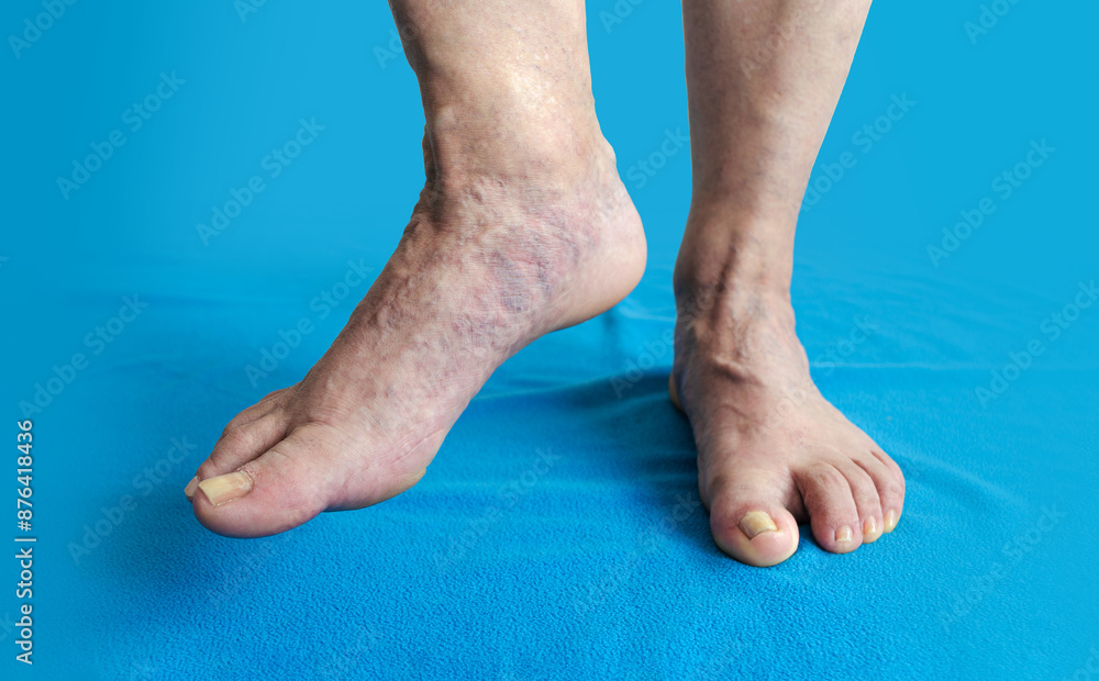 Várices y telangiectasias. Vasos sanguíneos pequeños y dilatados en ...