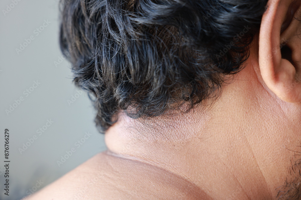 Asian men have a red, itchy, scaly rash skin rash caused by fungus ...