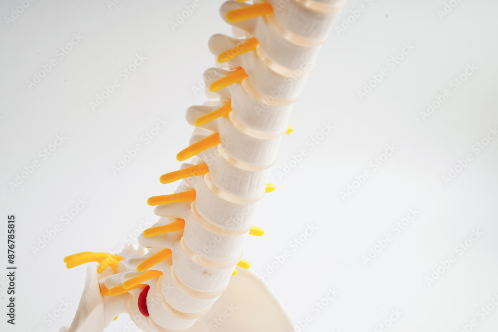 Spinal nerve and bone, Lumbar spine displaced herniated disc fragment ...
