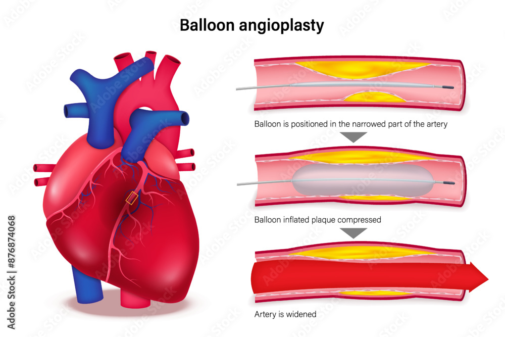 Steps of balloon angioplasty vector. Balloon in the treatment of ...