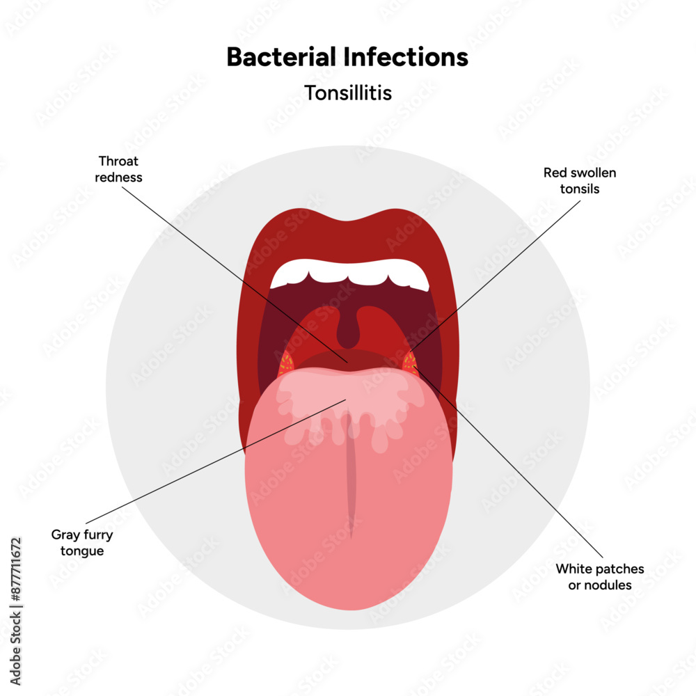 Viral bacterial infection, sore throat, tonsillitis medical diagram Stock Vector | Adobe Stock