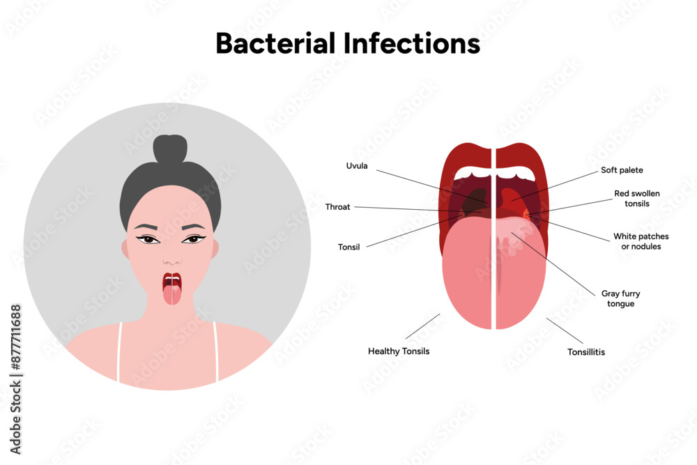 Woman with open mouth, viral bacterial infection, sore throat ...
