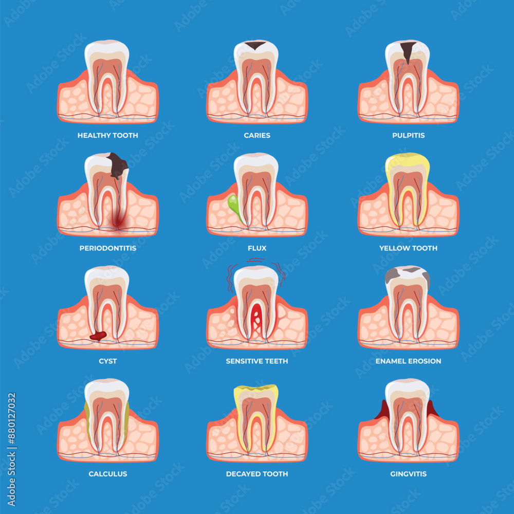 Set of different types of dental disease medical poster collection ...