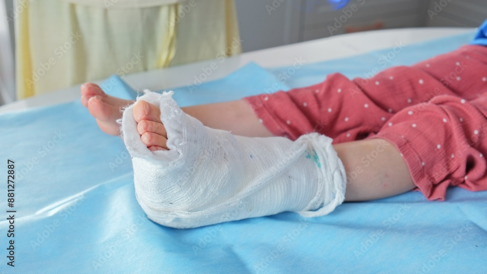 Caucasian Girl with Medical Plaster Short Leg Orthopedic Cast on After ...