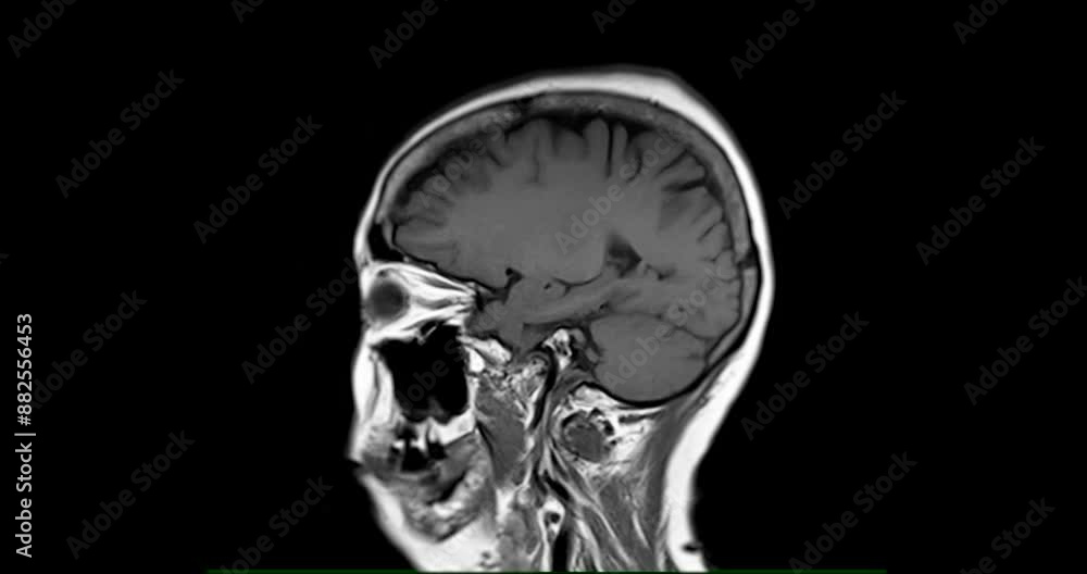 The MRI brain scan footage reveals intricate brain details, aiding in ...