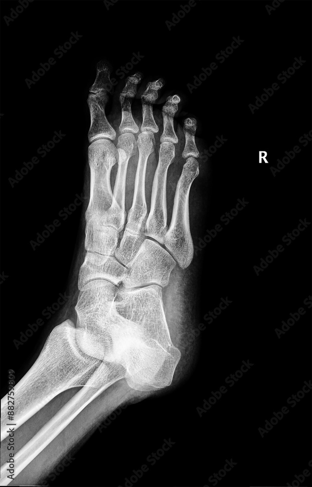 x-ray of foot fractured metatarsal bone. roken foot, oblique view, show ...