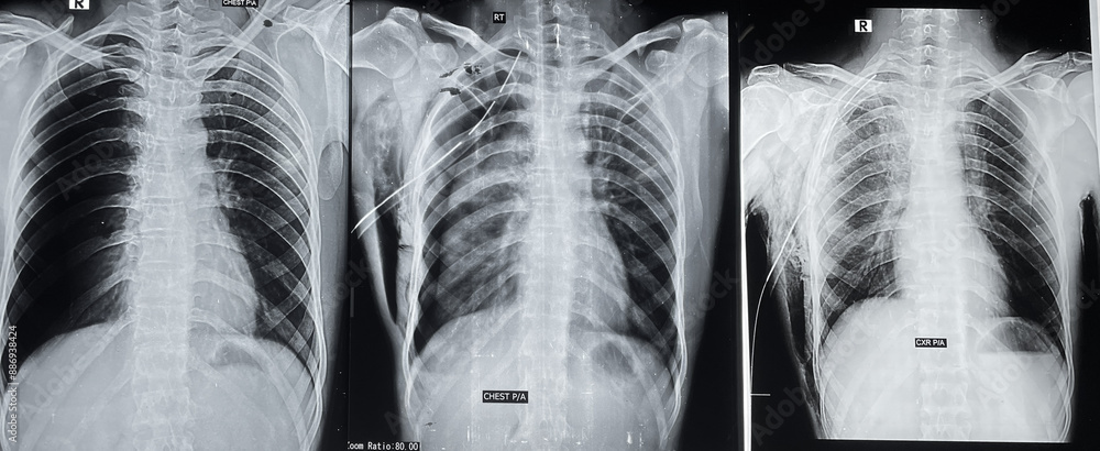 Chest x ray of pneumothorax and treatment by chest drain tube Stock ...