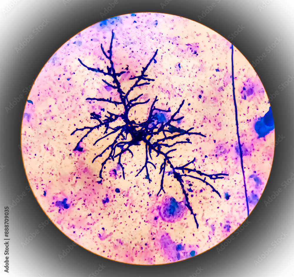 Candida Albicans yeast cell, pseudo hyphae with spores. Pseudohyphae ...