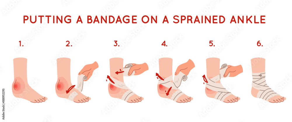 Applying elastic bandage to ankle. Foot injury. Soft tissues swelling ...