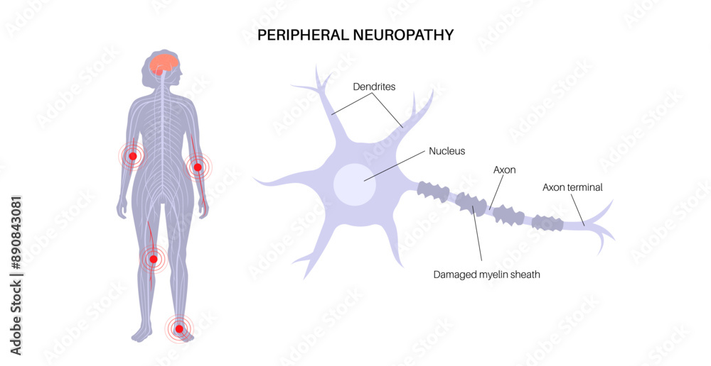 Photo & Art Print Peripheral neuropathy medical poster, pikovit