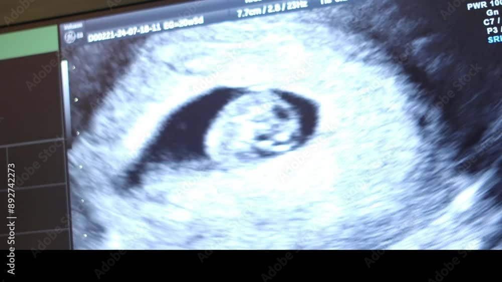 Vaginal ultrasound of a 7-8 week pregnant woman showing fetal heartbeat ...