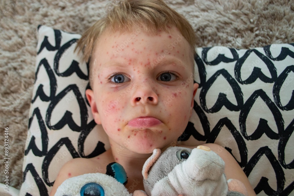 Natural vaccination. Contagious disease. Sick child with chickenpox ...