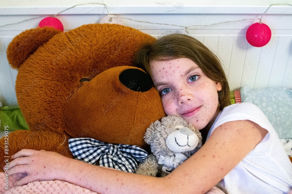 Natural vaccination. Contagious disease. Sick child with chickenpox ...
