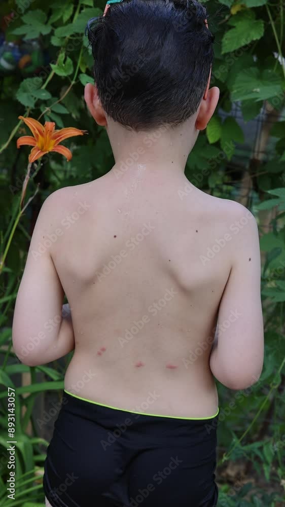kid back with lot of insects bites,mosquito or fleas, red spots. lying ...