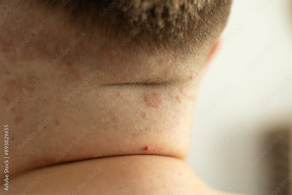 Psoriasis on the skin close-up, scalp, photos of dermatitis and eczema ...