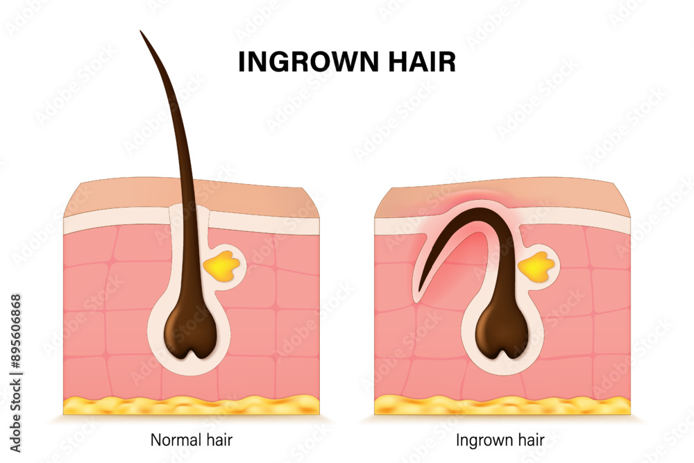 Normal and Ingrown hair. Structure of human hair follicle. Ingrown hair ...