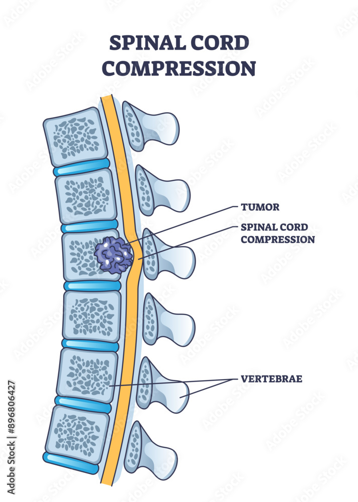 Spinal cord compression with tumor and vertebrae condition outline ...
