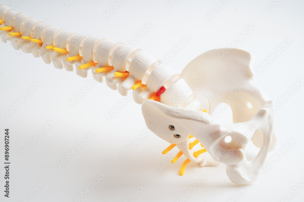 Fotografía Spinal nerve and bone, Lumbar spine displaced herniated disc ...