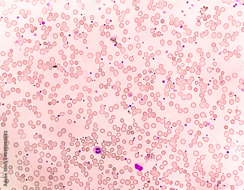 Anisocytosis anisochromia with both microcytic hypochromic and ...