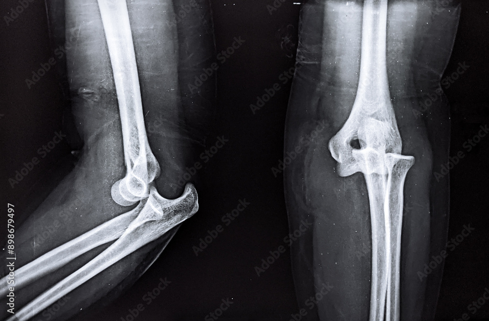 X ray film of posterior dislocation of elbow joint Stock Photo | Adobe ...