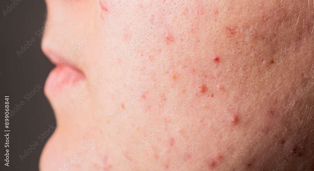 Pimple on face. Skin texture. Closeup acne skin. Treatment for skin ...