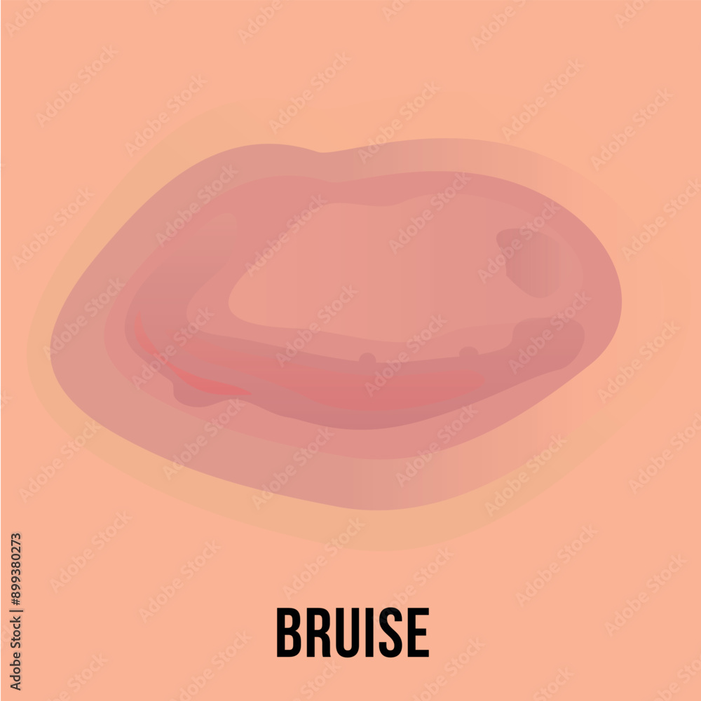 Understanding skin diseases through detailed depiction of bruise on ...